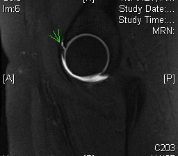 Labral Tears of the Hip | Dr Wind | Richmond VA | Orthopedic Surgeon ...